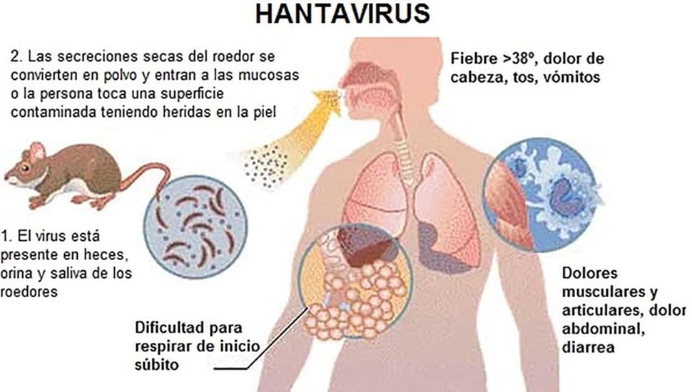Hantavirus La Enfermedad Que Tiene En Vilo A La Patagonia