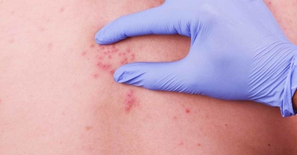 Cómo curar la culebrilla: síntomas y tratamiento